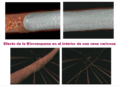 Tratamiento varices: La microespuma para varices del Dr Cabrera